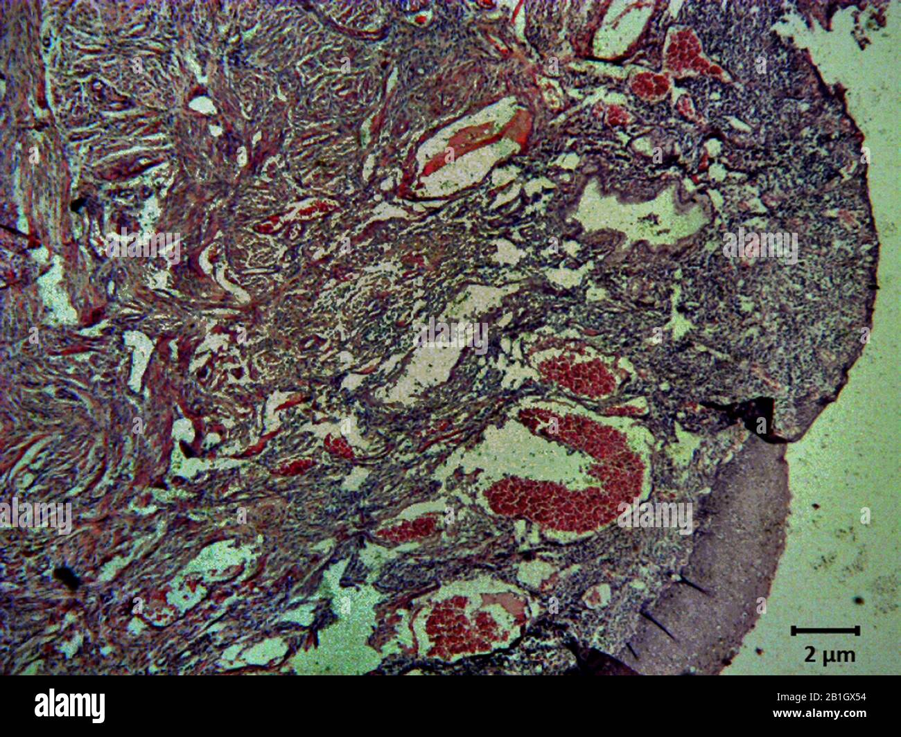 coupe histologique du tissu du cancer du col de l'utérus, 200 fois ...