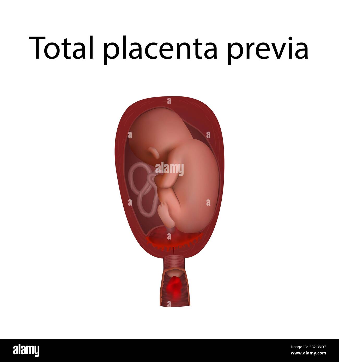 Placenta previa Banque de photographies et d’images à haute résolution ...