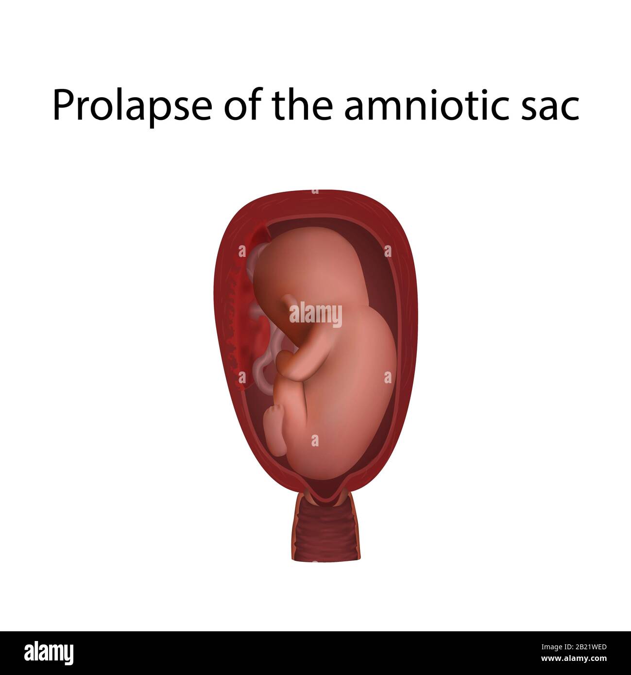 Prolapsus col utérin Banque de photographies et d’images à haute ...