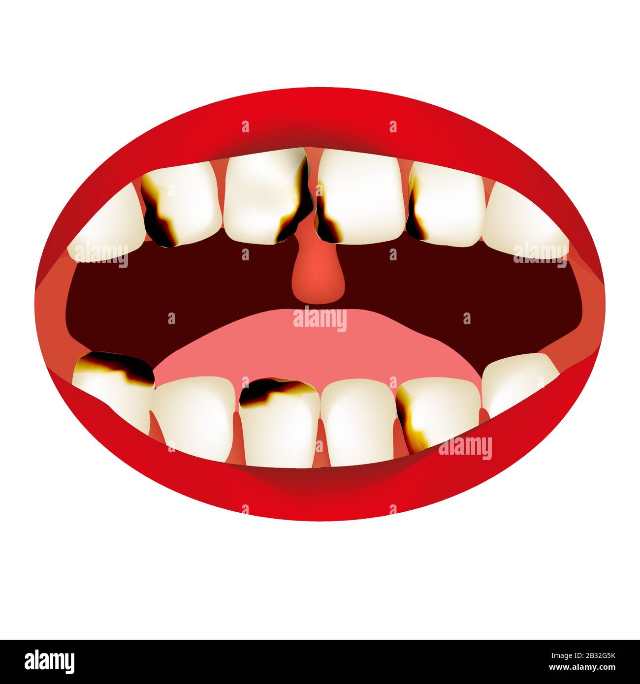 caries. Odeur de la bouche. Halose. La structure des dents et de la ...