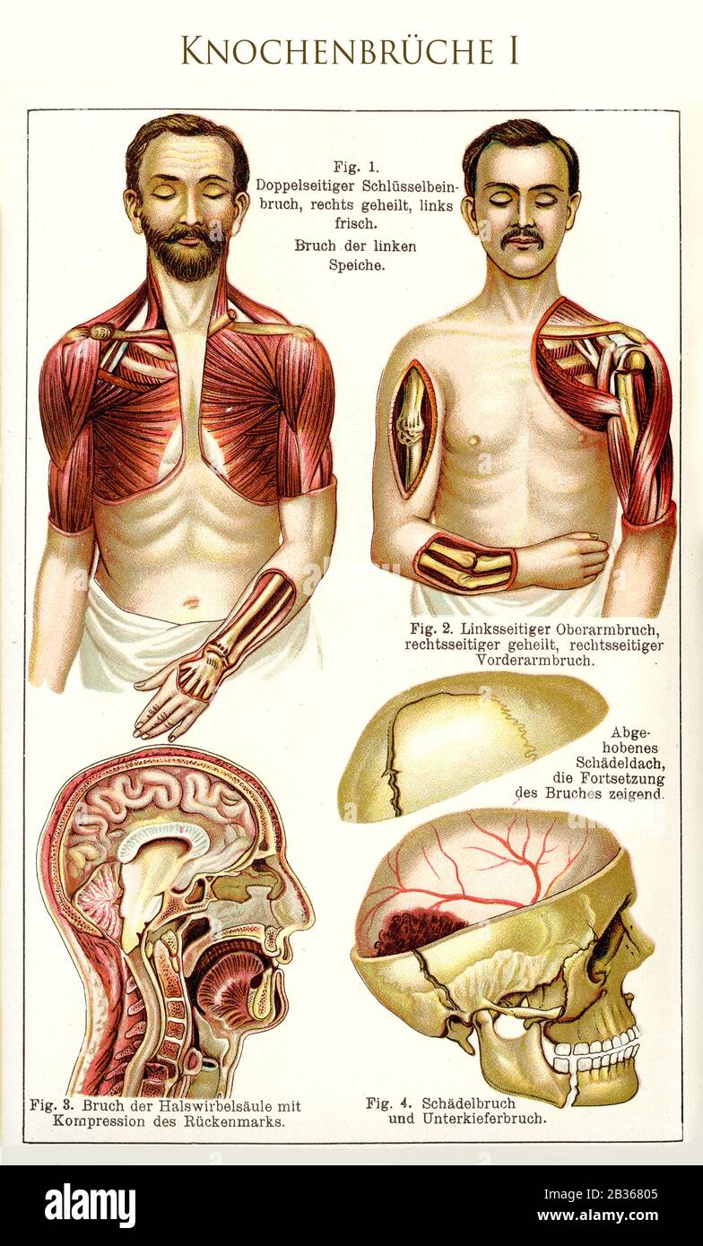 Santé et médecine: Fractures osseuses table de couleurs I avec ...