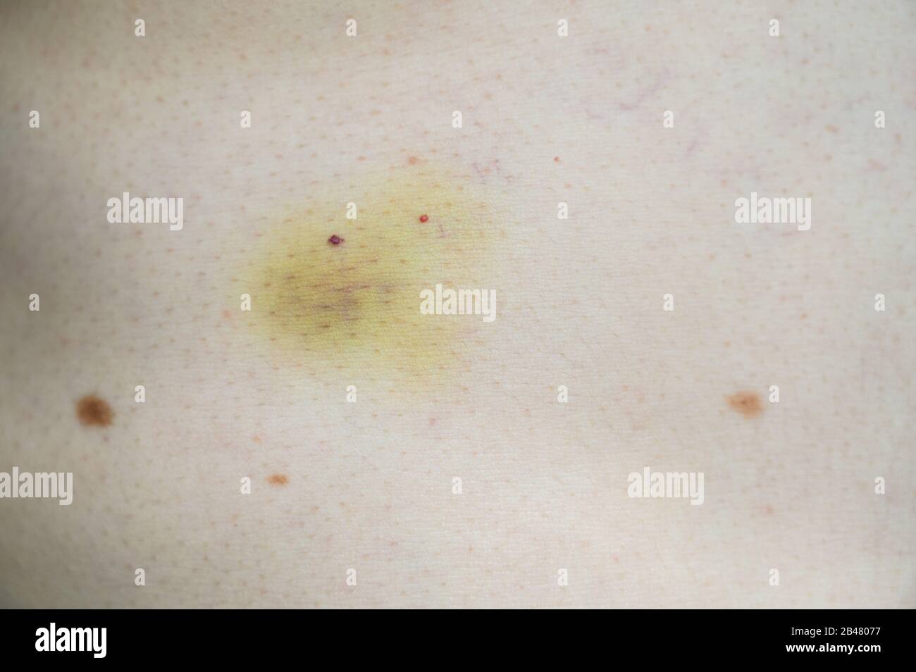 Ecchymose sur la peau Banque de photographies et d’images à haute ...