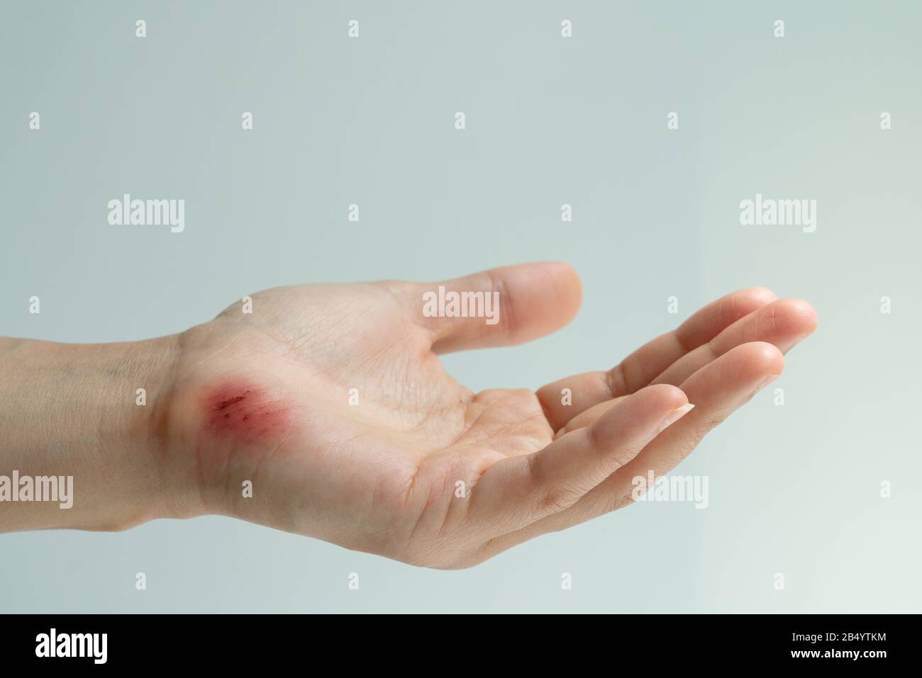 Peau Écorchée Banque d'image et photos - Alamy