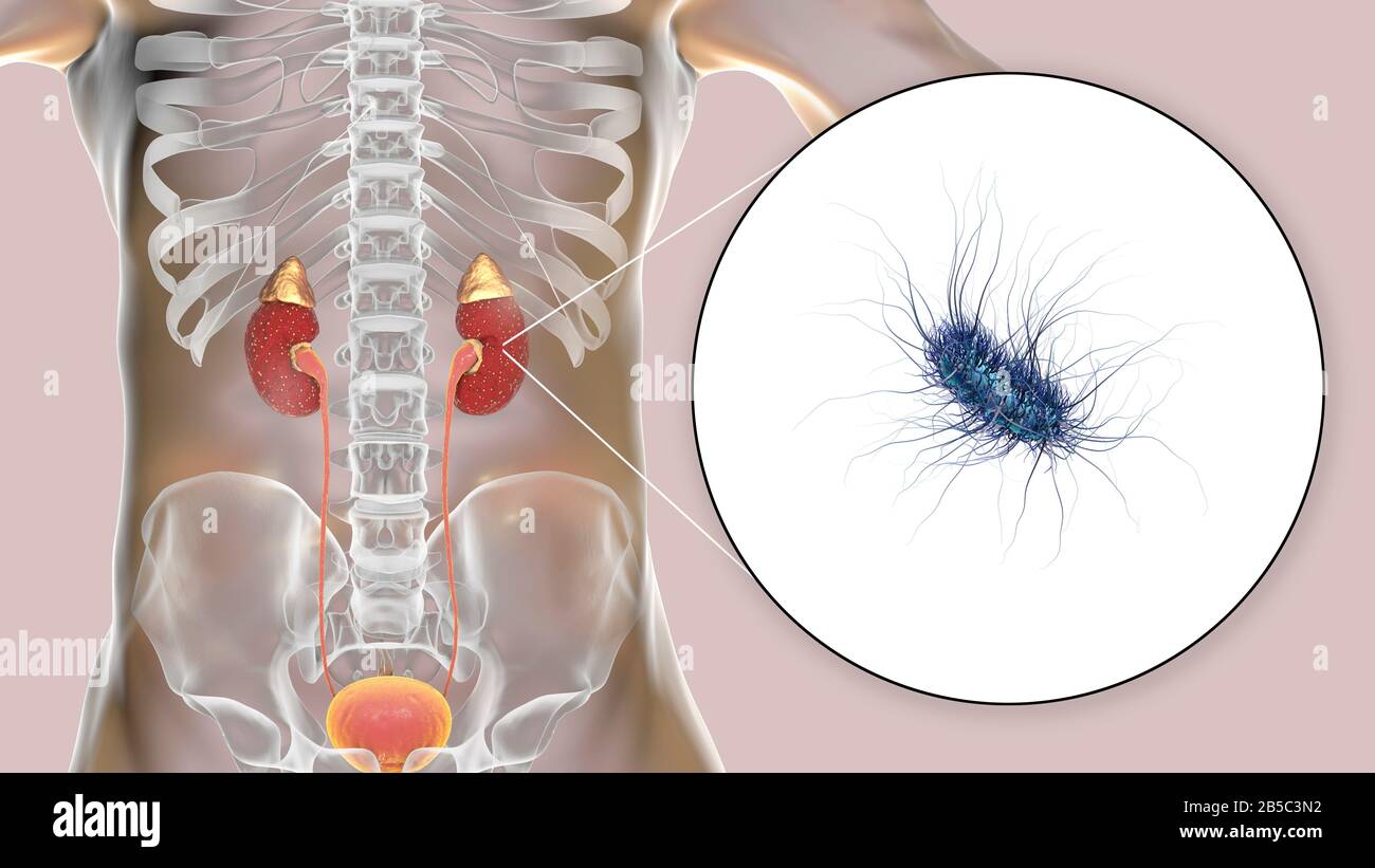 Pyélonéphrite aiguë causée par e coli Banque de photographies et d ...