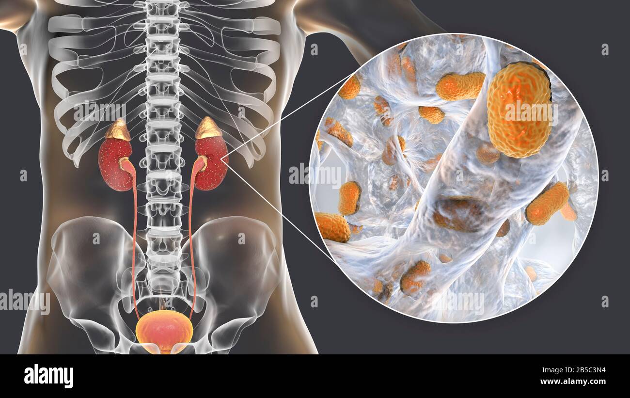 Acute pyelonephritis Banque de photographies et d’images à haute ...