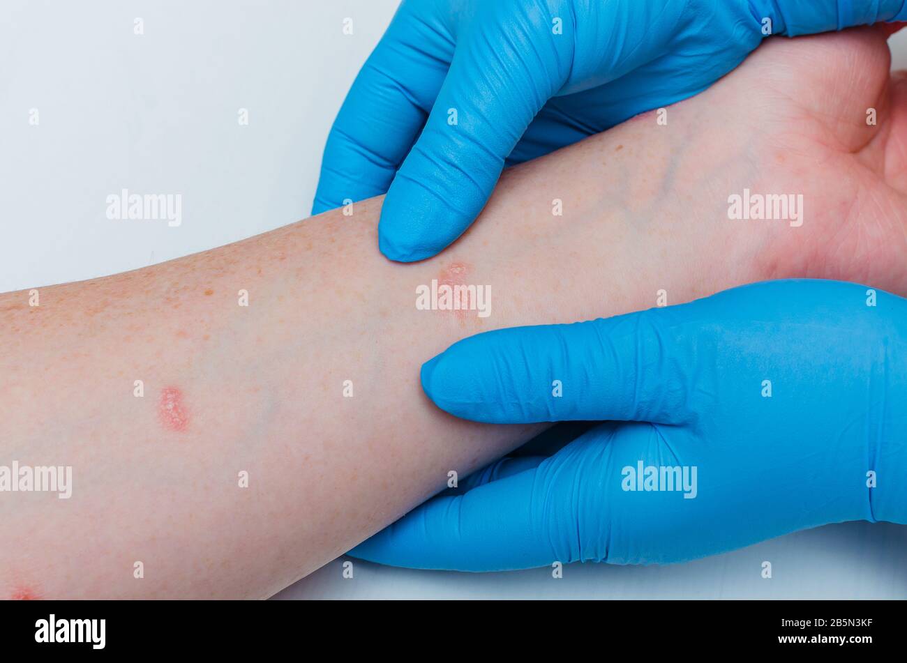 Tache rouge peau psoriasis Banque de photographies et d’images à haute ...