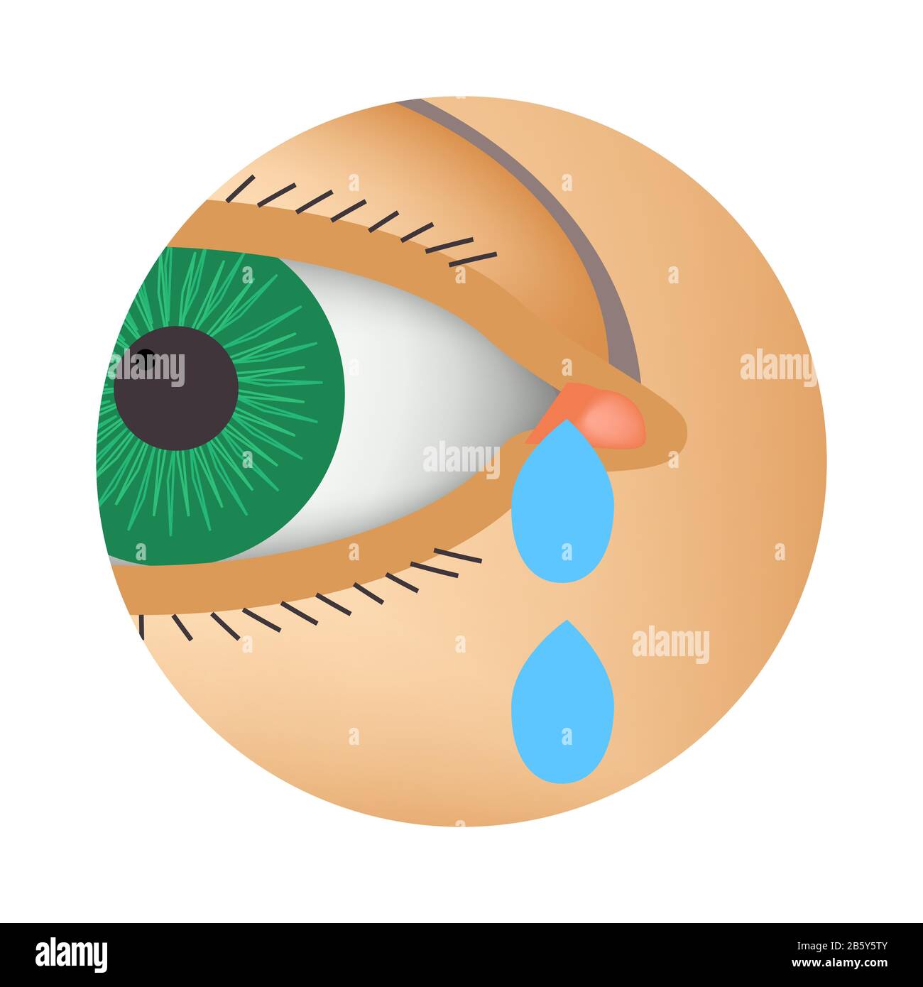 Lacrimation des yeux. Symptôme de conjonctivite, d'allergies, d ...