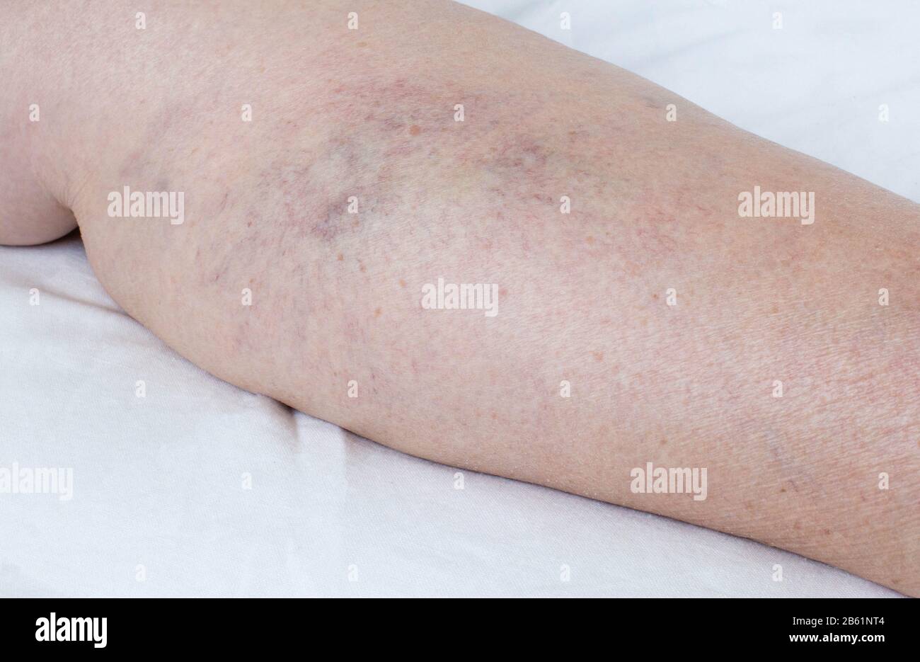 Varices Jambes Banque d'image et photos - Page 3 - Alamy