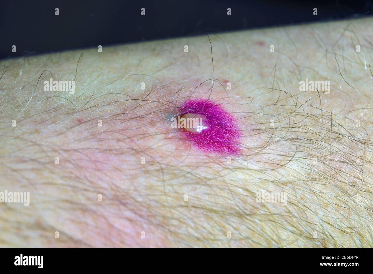 Varicella zoster virus Banque de photographies et d’images à haute ...