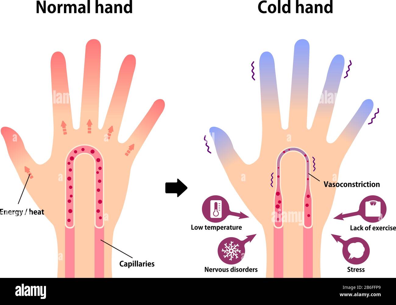 Illustration de comparaison de la main normale et de la main froide ...