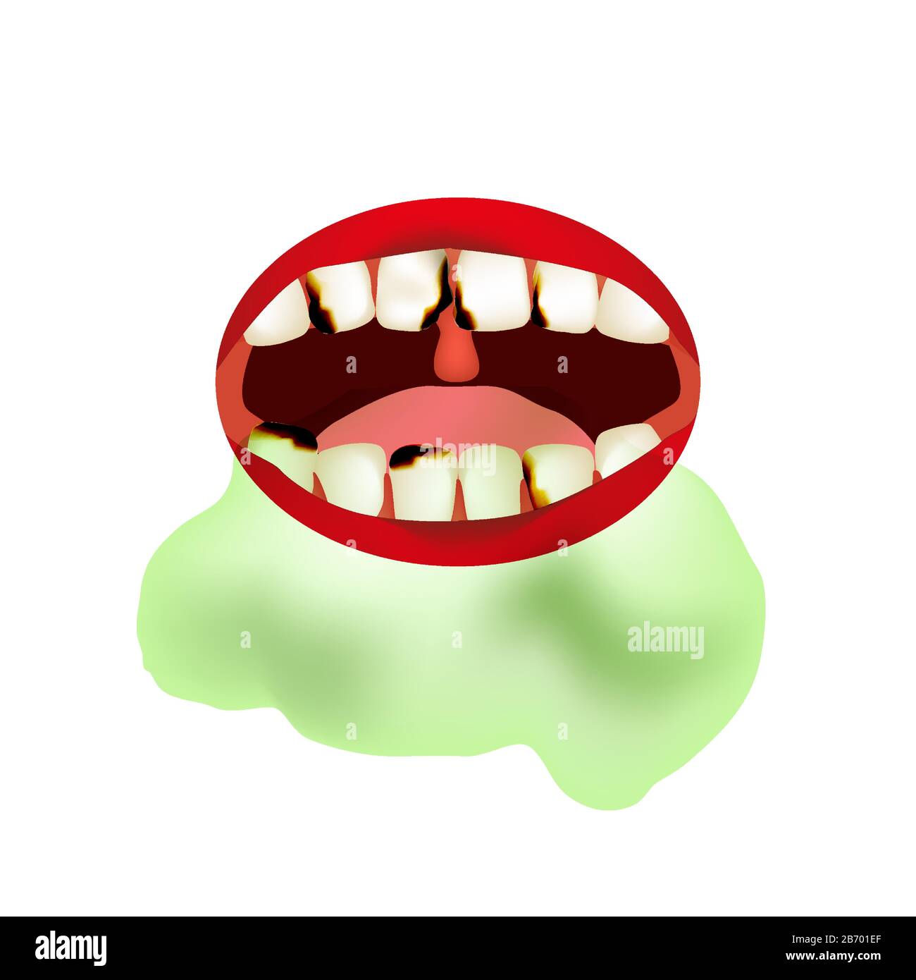 caries. Odeur de la bouche. Halose. La structure des dents et de la ...