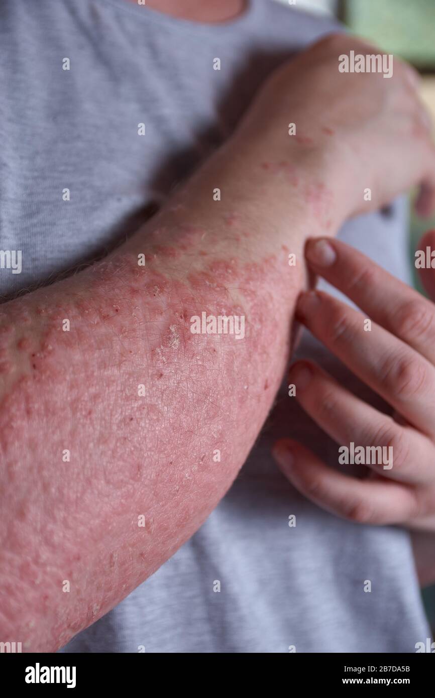 Peau De Psoriasis Jambe Banque d'image et photos - Alamy