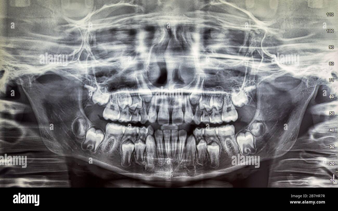 Radiographie dentaire d'un patient adulte, radiologie numérique moderne ...