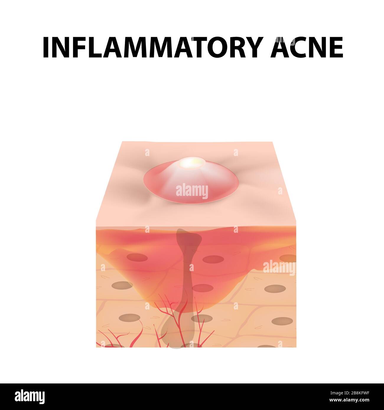 Acné de kyste. Acné sur la peau d'un kyste. Maladies dermatologiques et ...