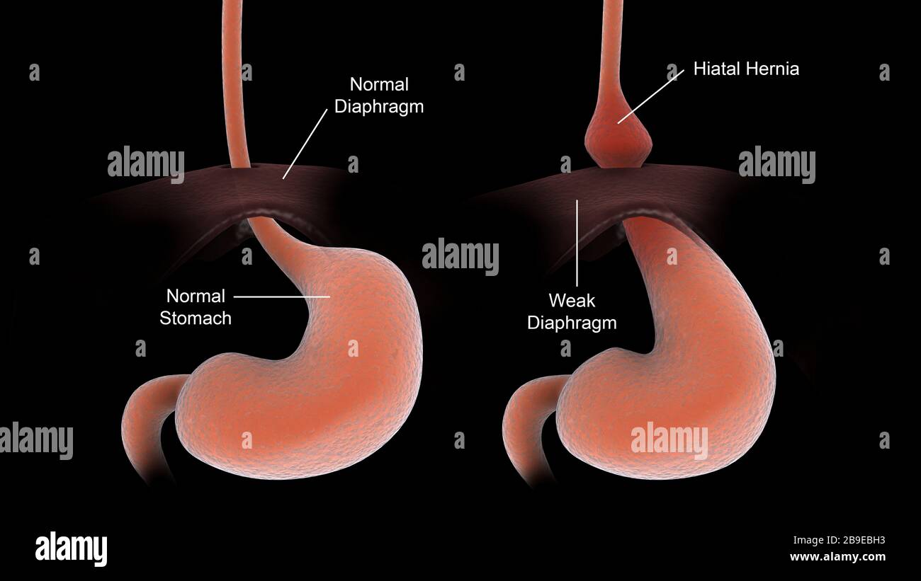 Un estomac humain sain comparé à un estomac humain malsain avec hernie ...