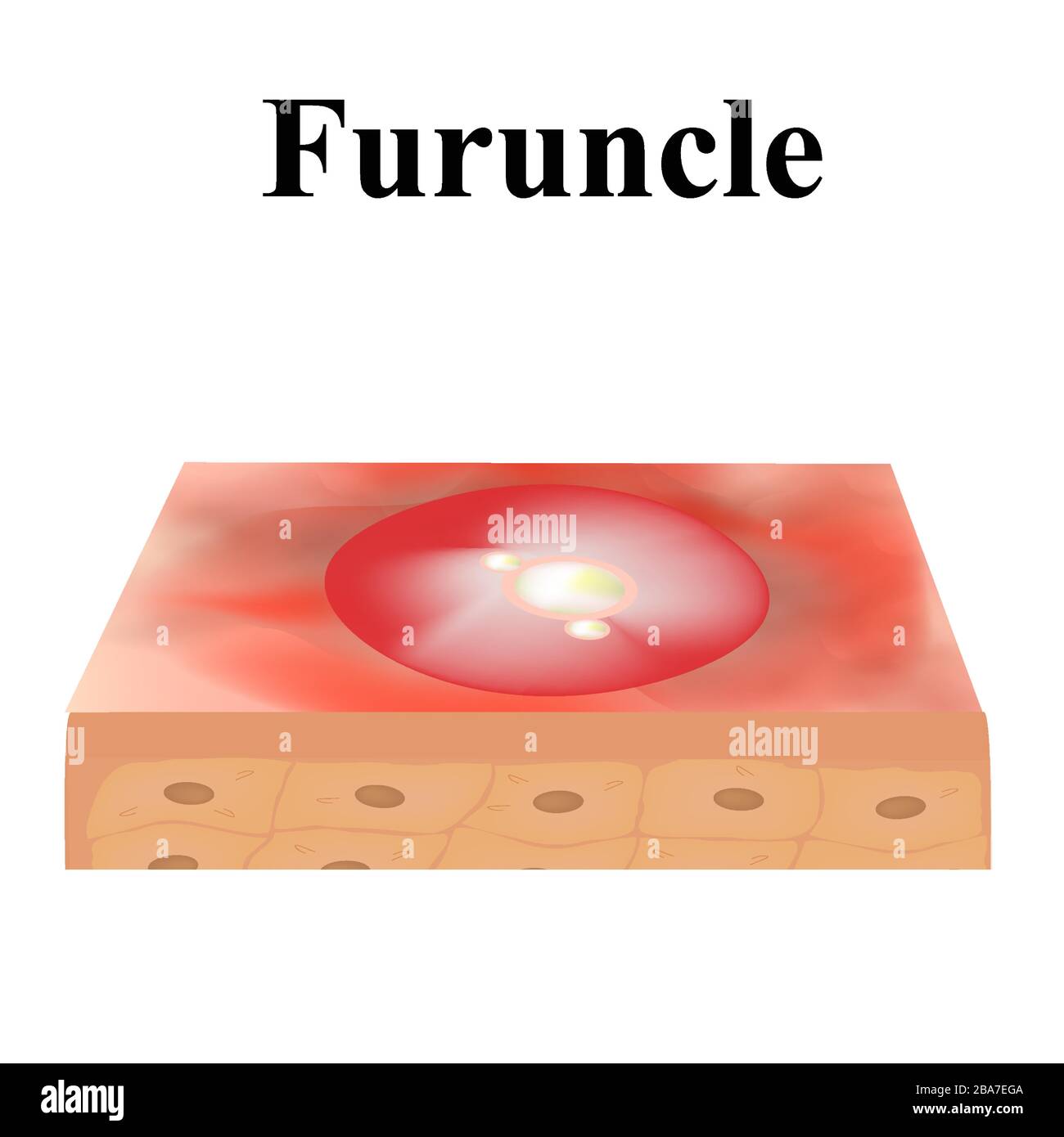 Acné de kyste. furoncle acné sur la peau kystes et boutons. Maladies ...