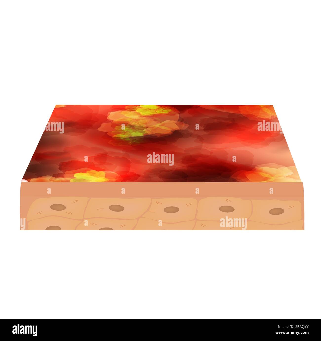 Acné de kyste. furoncle acné sur la peau kystes et boutons. Maladies ...