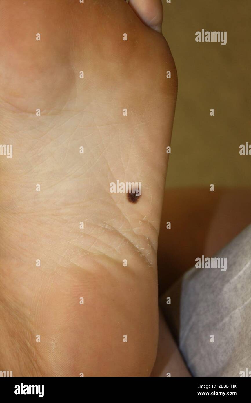 Cancer de la peau sur bas du pied Banque de photographies et d’images à ...