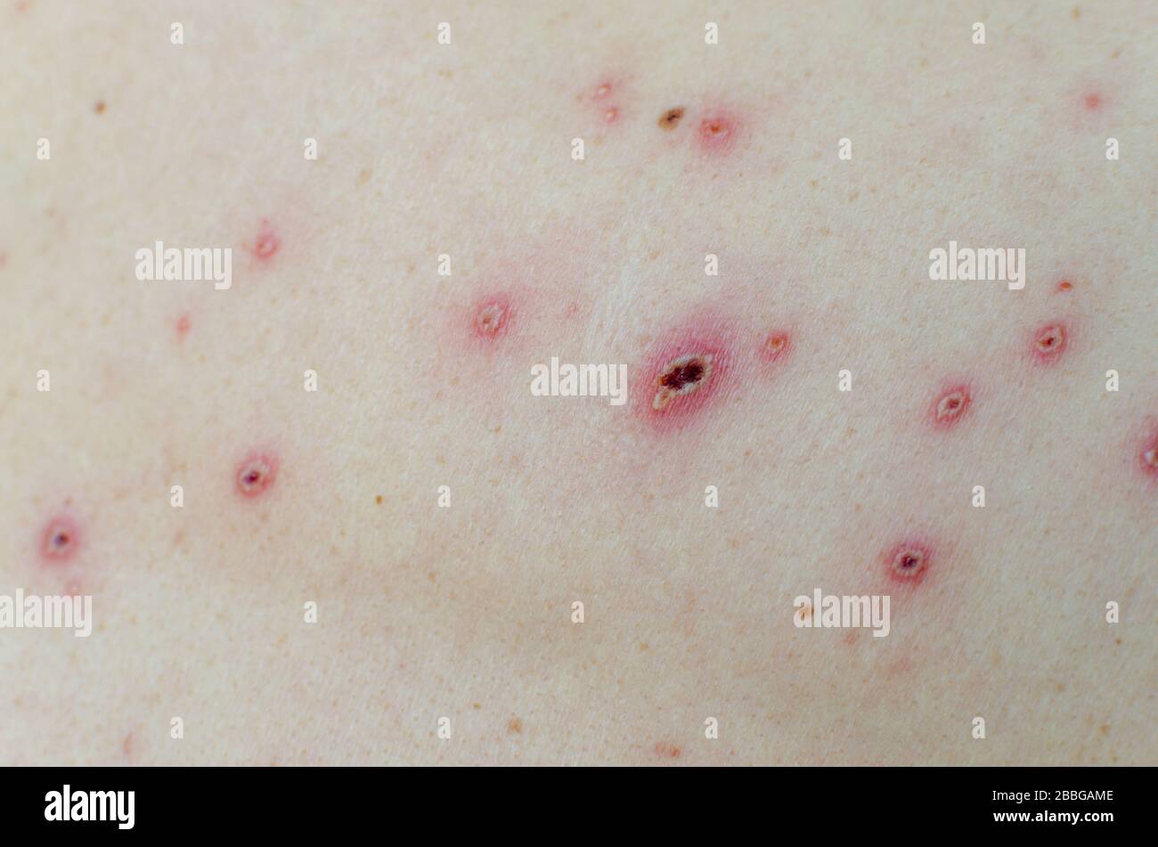 Varicelle virus adulte homme peau du corps Banque de photographies et d ...