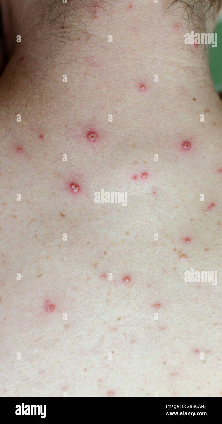 Varicelle virus adulte homme peau du corps Banque de photographies et d ...