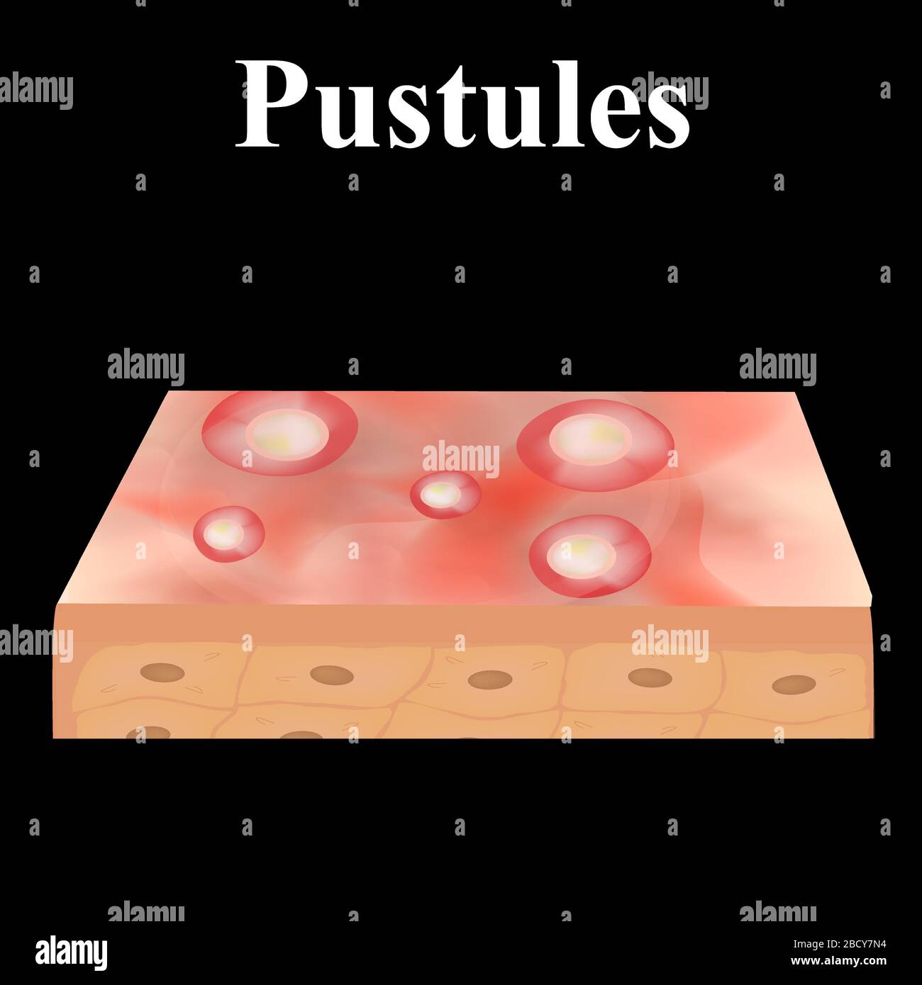 Acné de kyste. Acné sur la peau d'un kyste. Maladies dermatologiques et ...