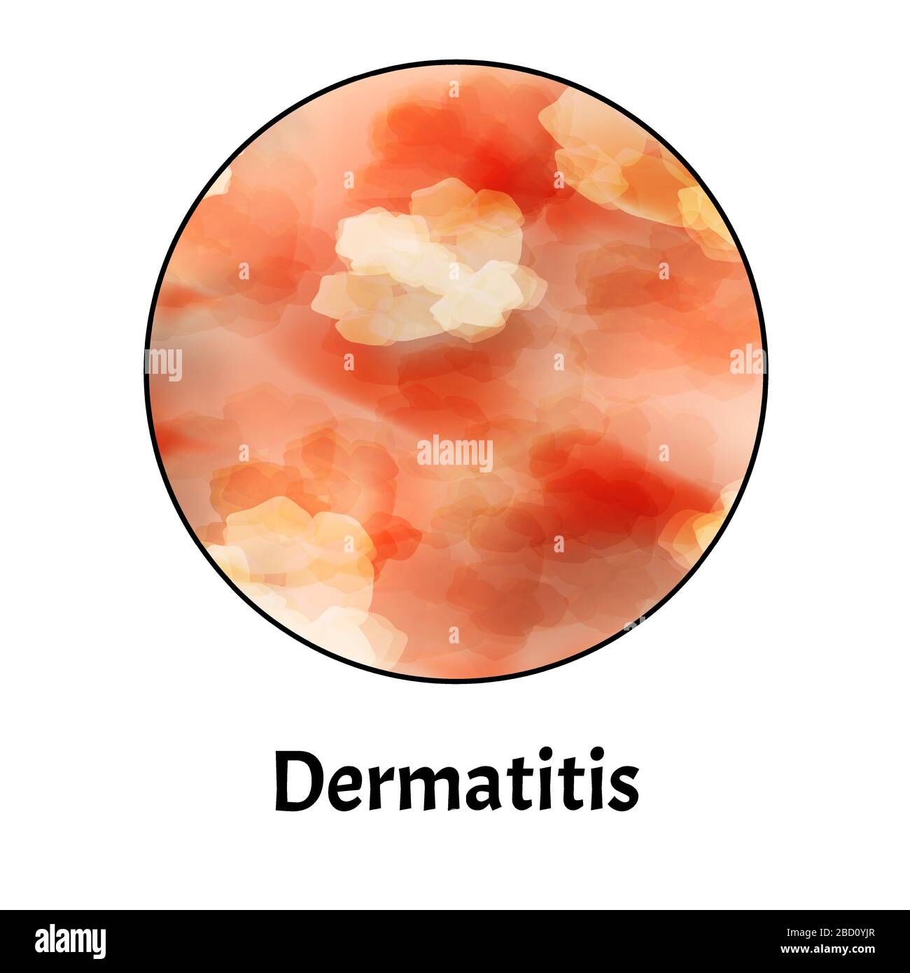 Inflammation de la peau. Dermatite cutanée. Infographies. Illustration ...