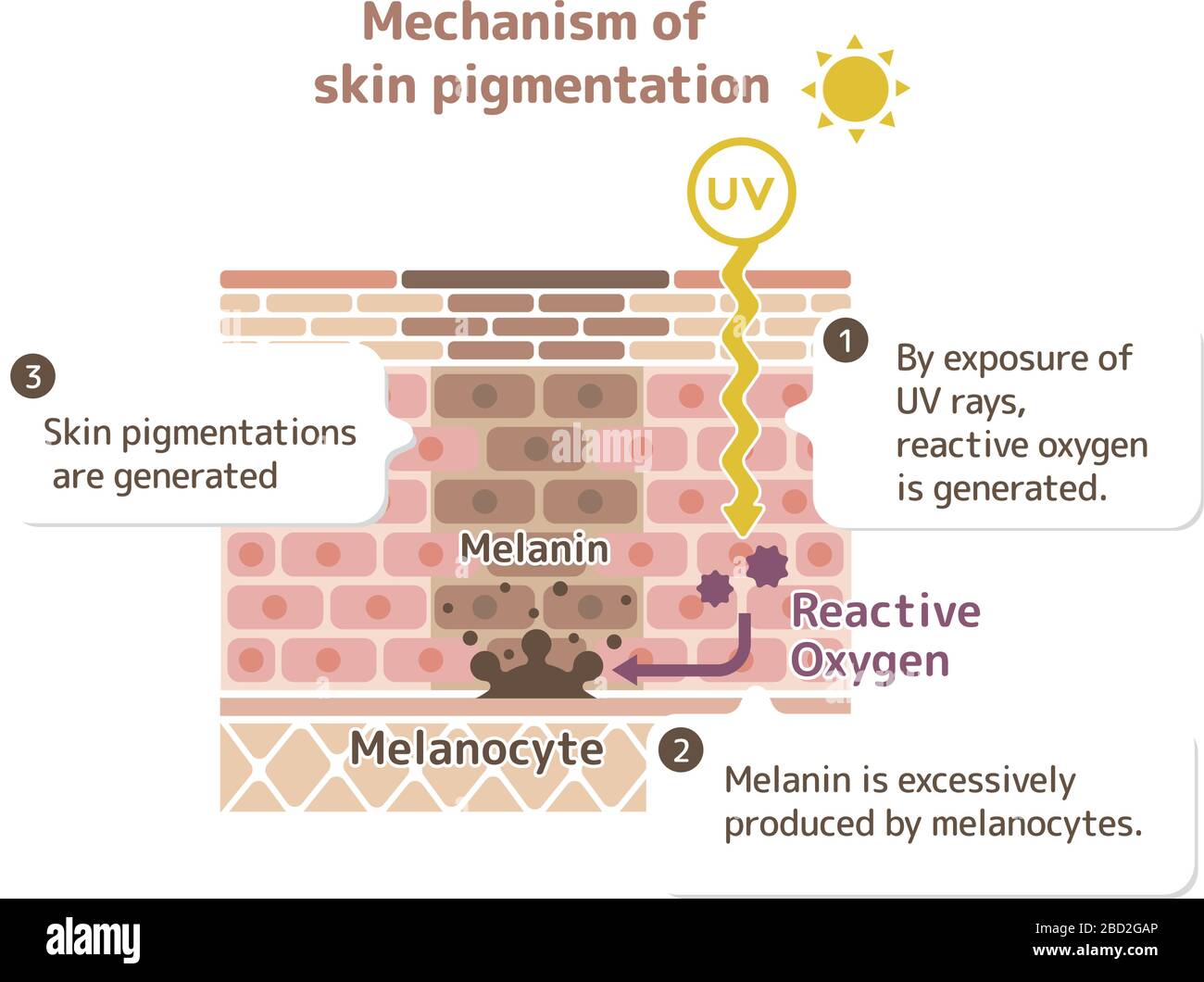 mécanisme de pigmentation de la peau / illustration de tache de peau ...
