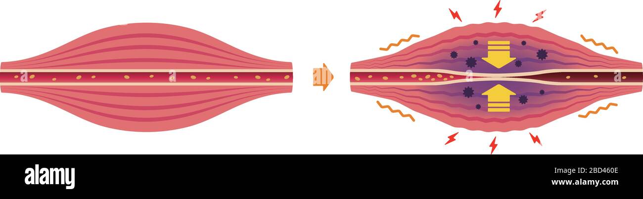 Raideur corporelle Banque de photographies et d’images à haute ...