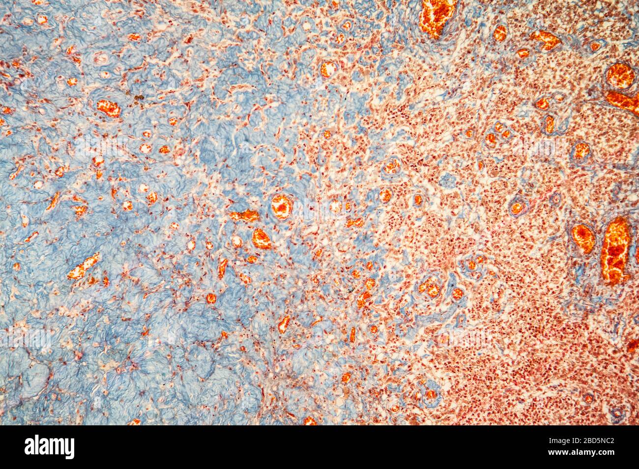 Mélanome cancer de la peau Banque de photographies et d’images à haute résolution - Page 2 - Alamy