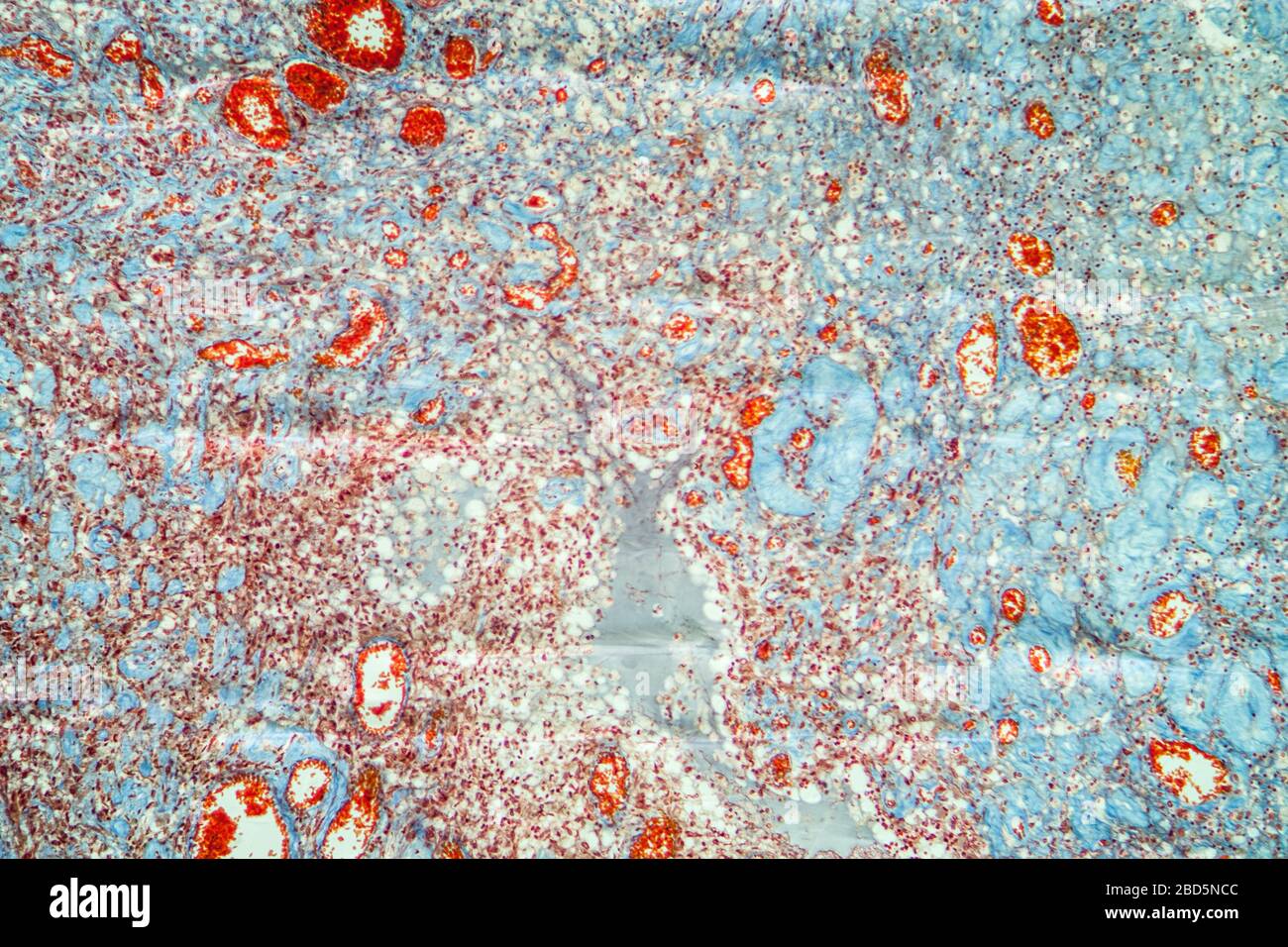 Mélanome cancer de la peau Banque de photographies et d’images à haute résolution - Page 2 - Alamy