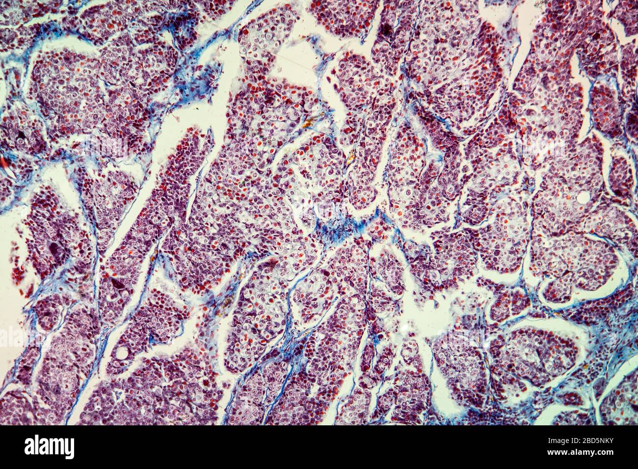 Cancer basocellulaire Banque de photographies et d’images à haute ...