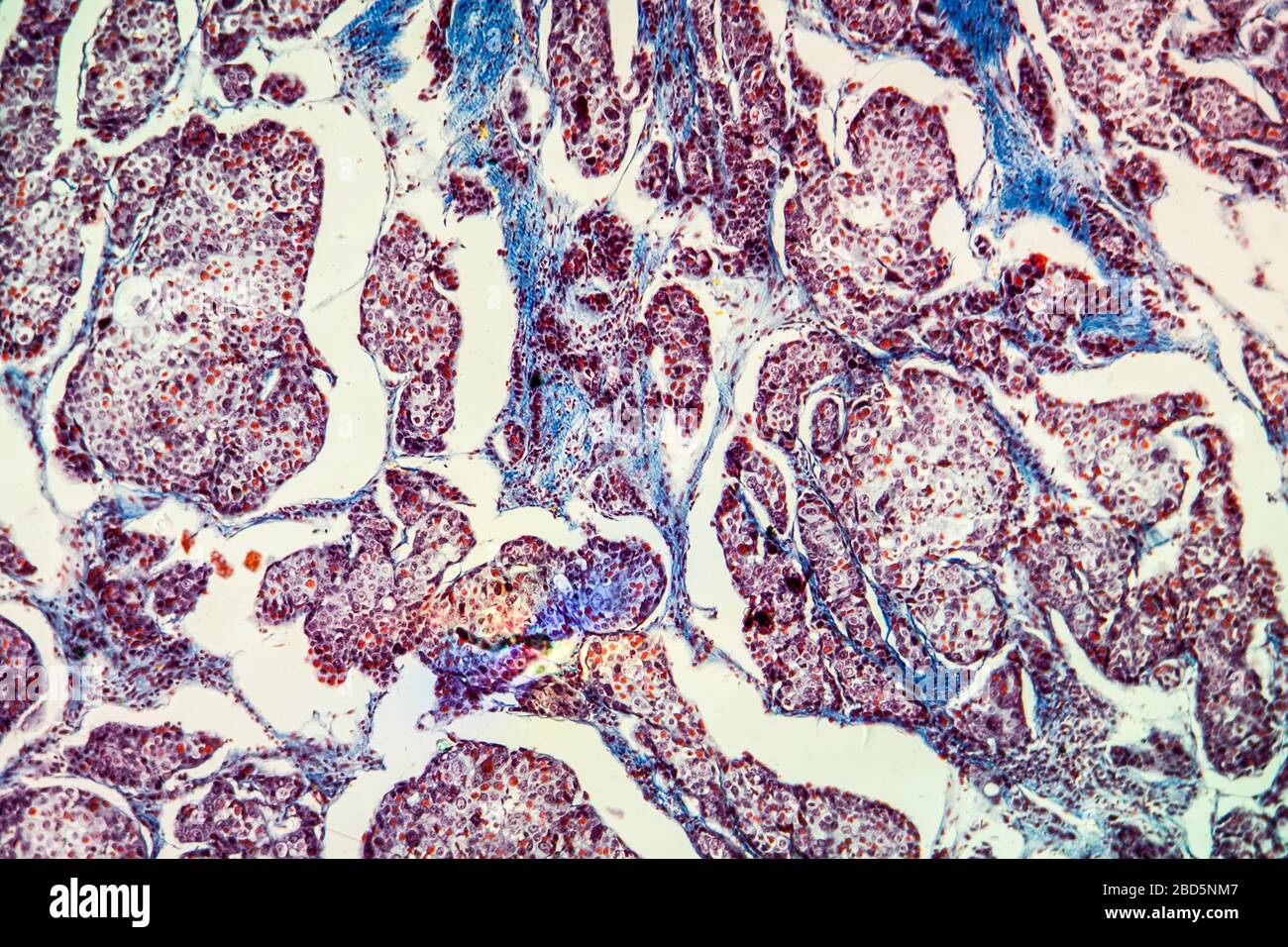 Cancer basocellulaire Banque de photographies et d’images à haute ...