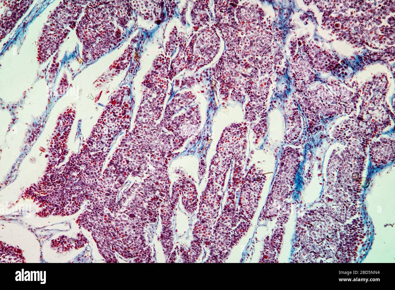 Le carcinome basocellulaire tissu malade 100x Photo Stock - Alamy