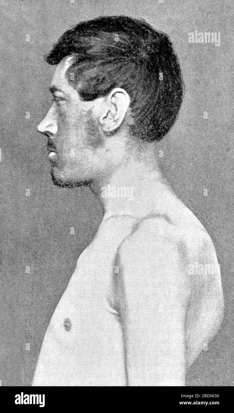 Acromégalie Banque de photographies et d’images à haute résolution - Alamy