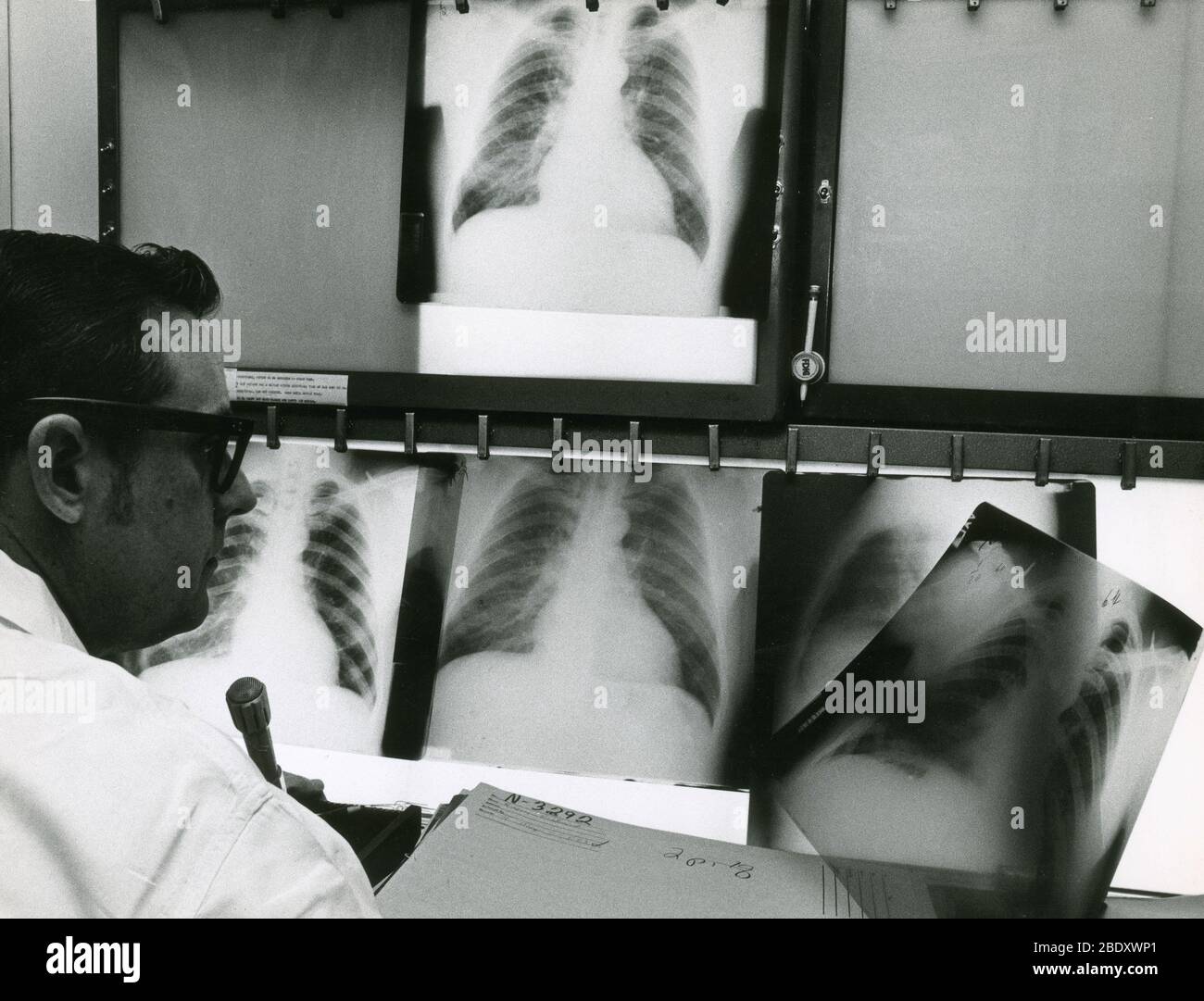 Maladie pulmonaire noire Photo Stock - Alamy
