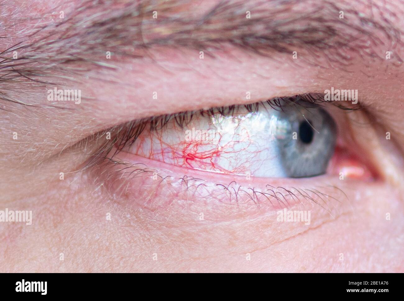 Rougeur oculaire Banque de photographies et d’images à haute résolution ...