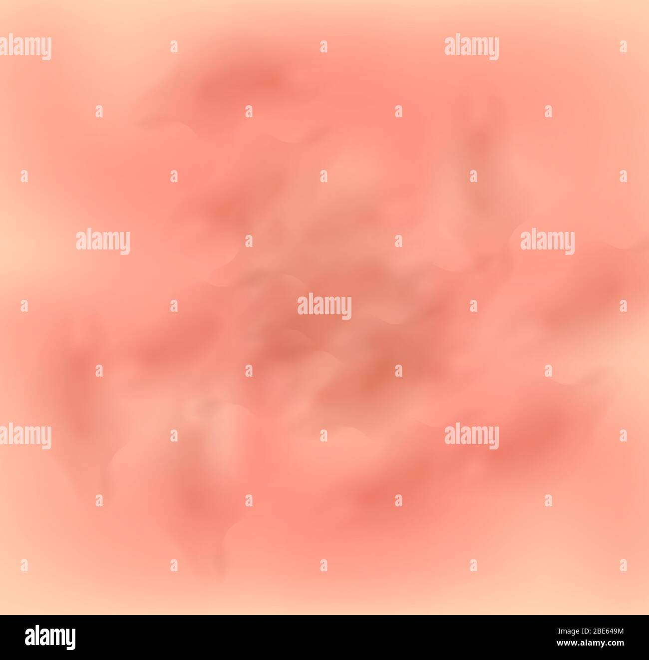 Inflammation de la peau. Dermatite cutanée. Infographies. Arrière-plan ...