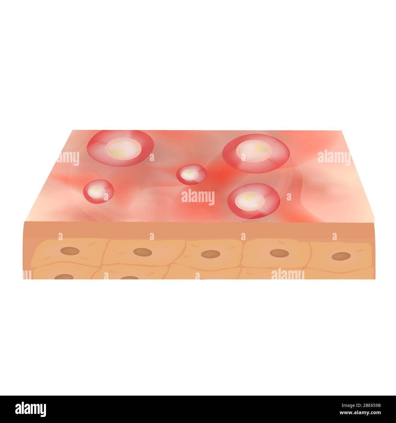 Pustules. Acné sur la peau. Maladies dermatologiques et cosmétiques sur ...