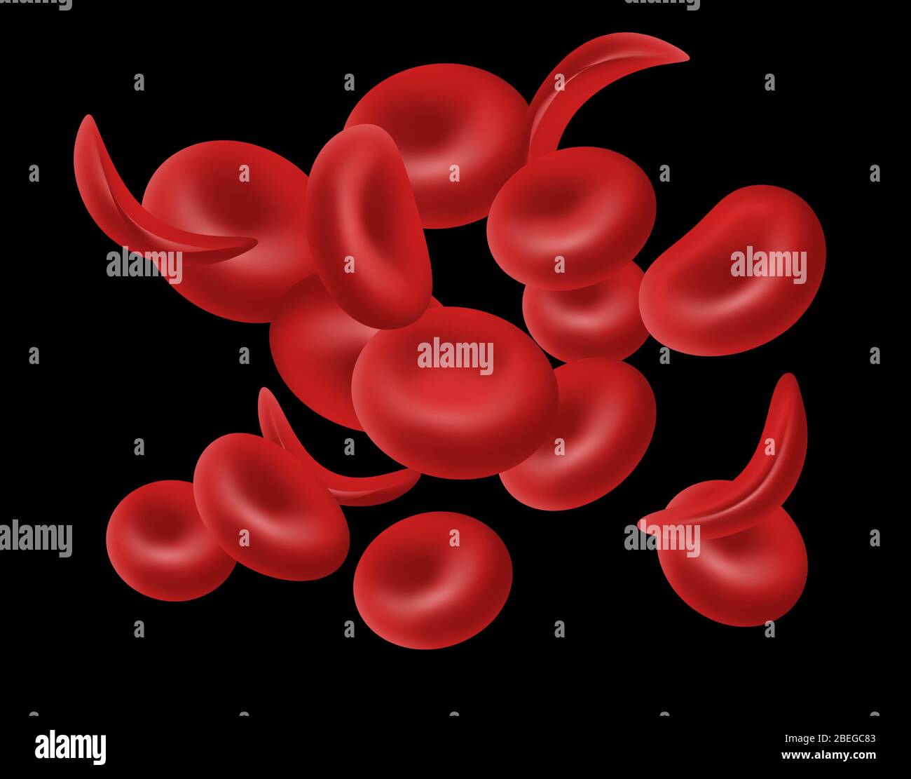 Sickle cell disease Banque de photographies et d’images à haute ...
