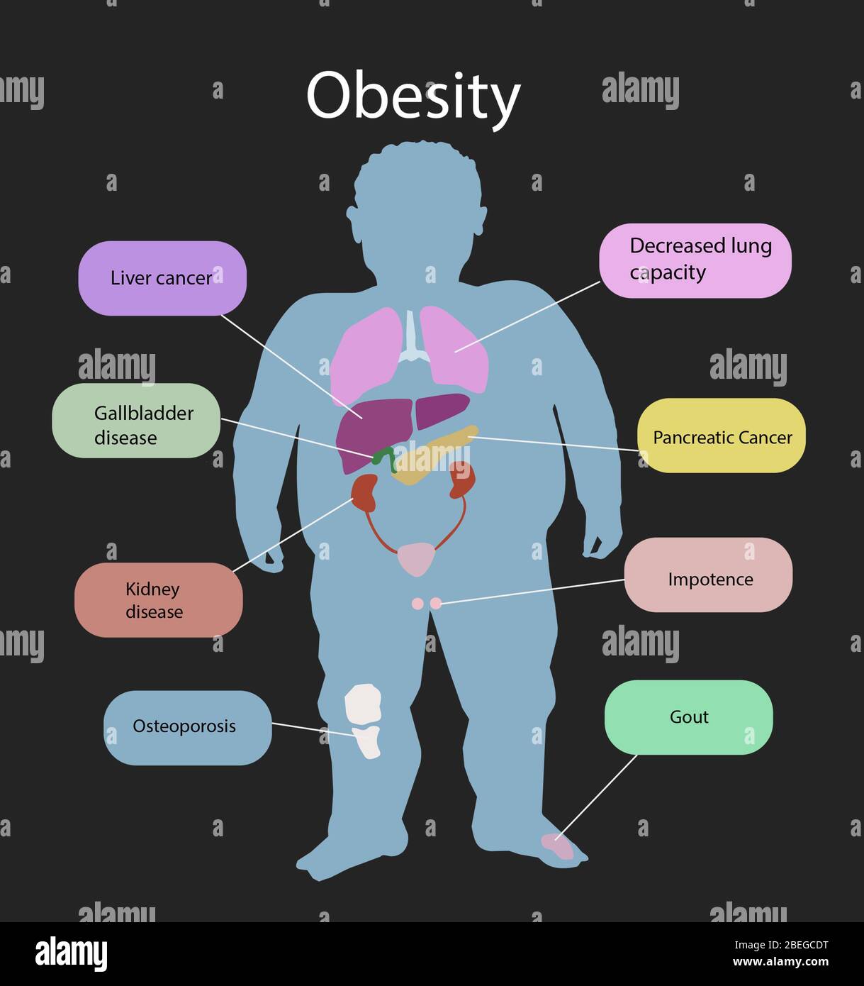 Obesity illustration Banque de photographies et d’images à haute ...