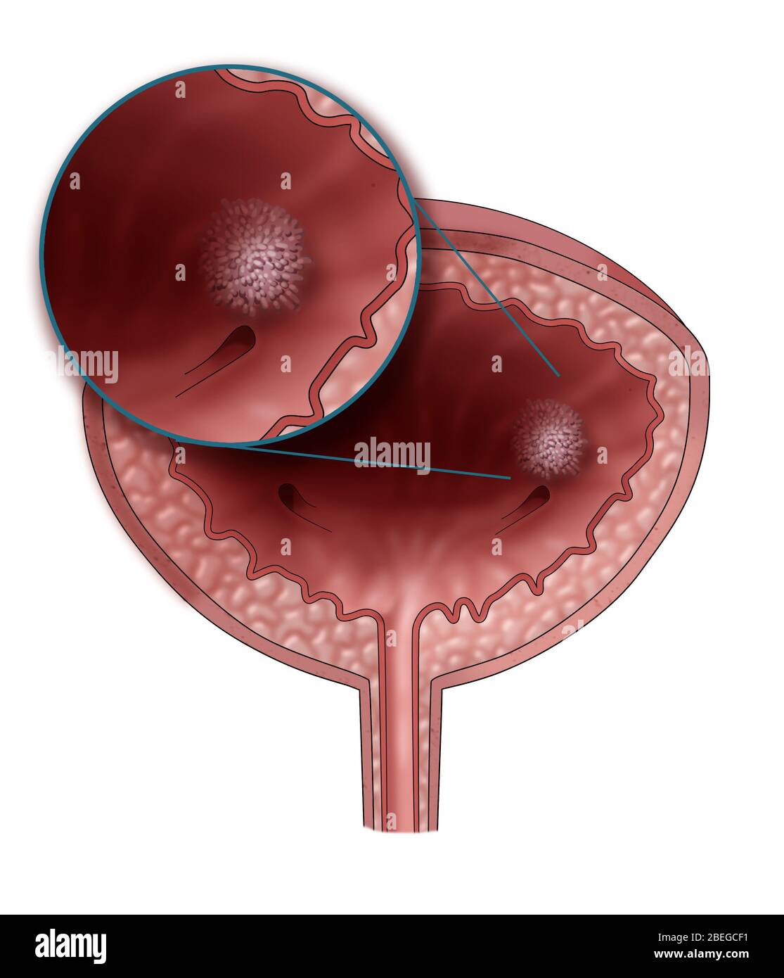 Cancer de la vessie, illustration Photo Stock - Alamy
