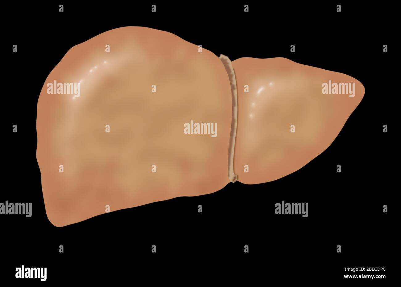 La maladie du foie gras humain Banque de photographies et d’images à ...