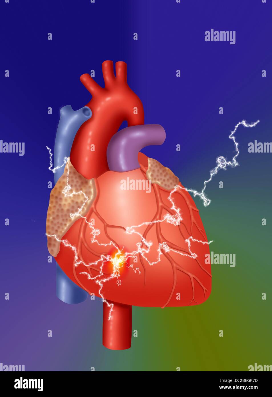 Crise cardiaque coronaire Banque de photographies et d’images à haute ...
