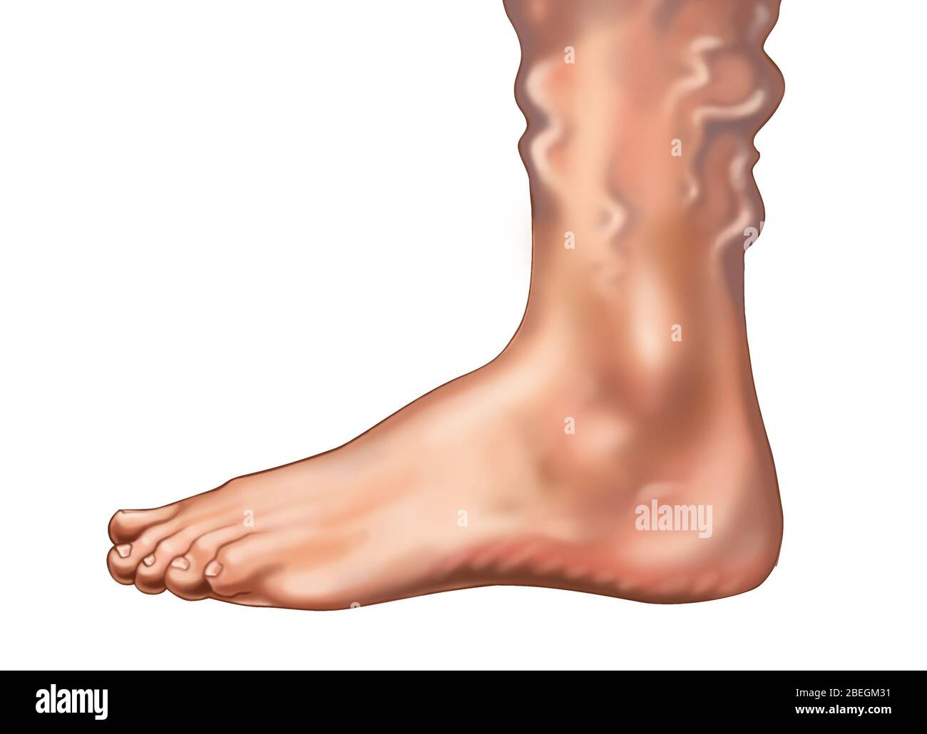 Varicose veins feet Banque d'images détourées - Alamy