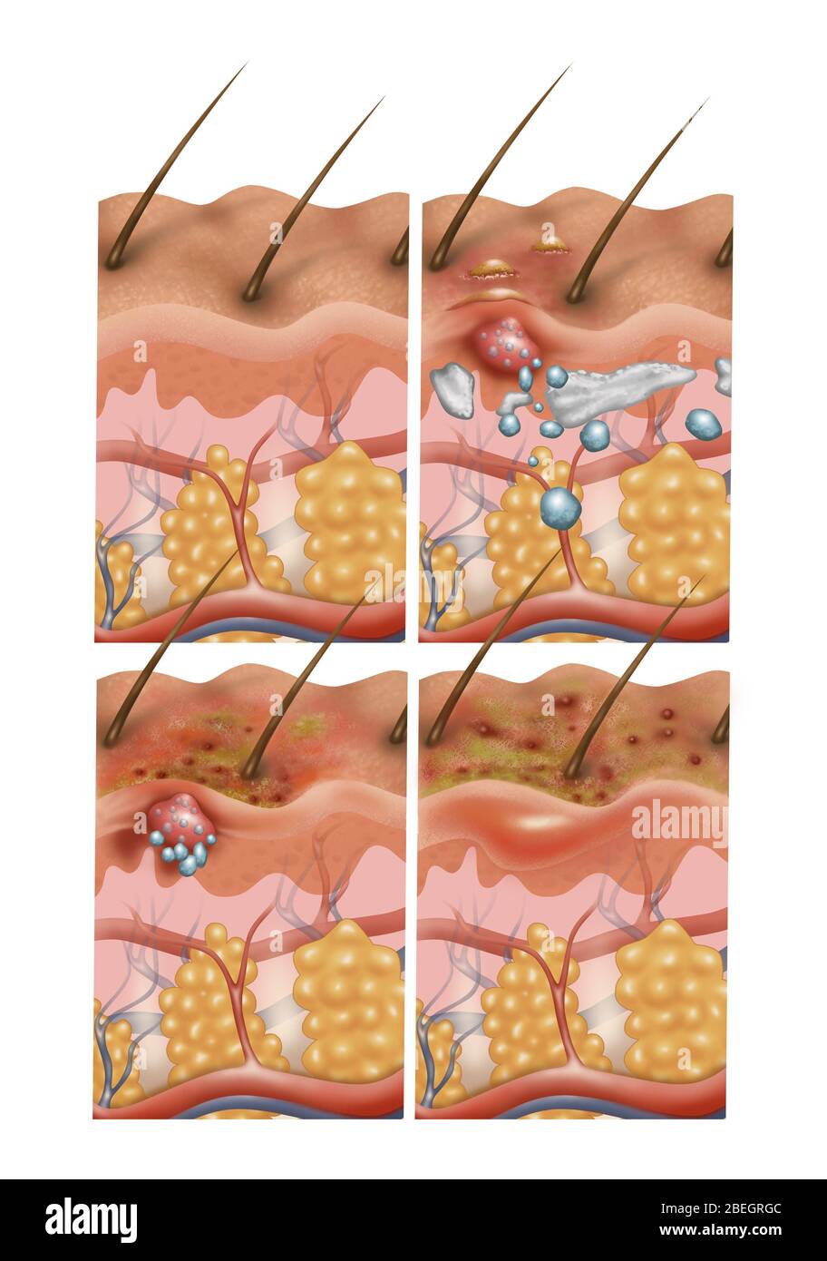 Dermatite chronique Banque de photographies et d’images à haute ...