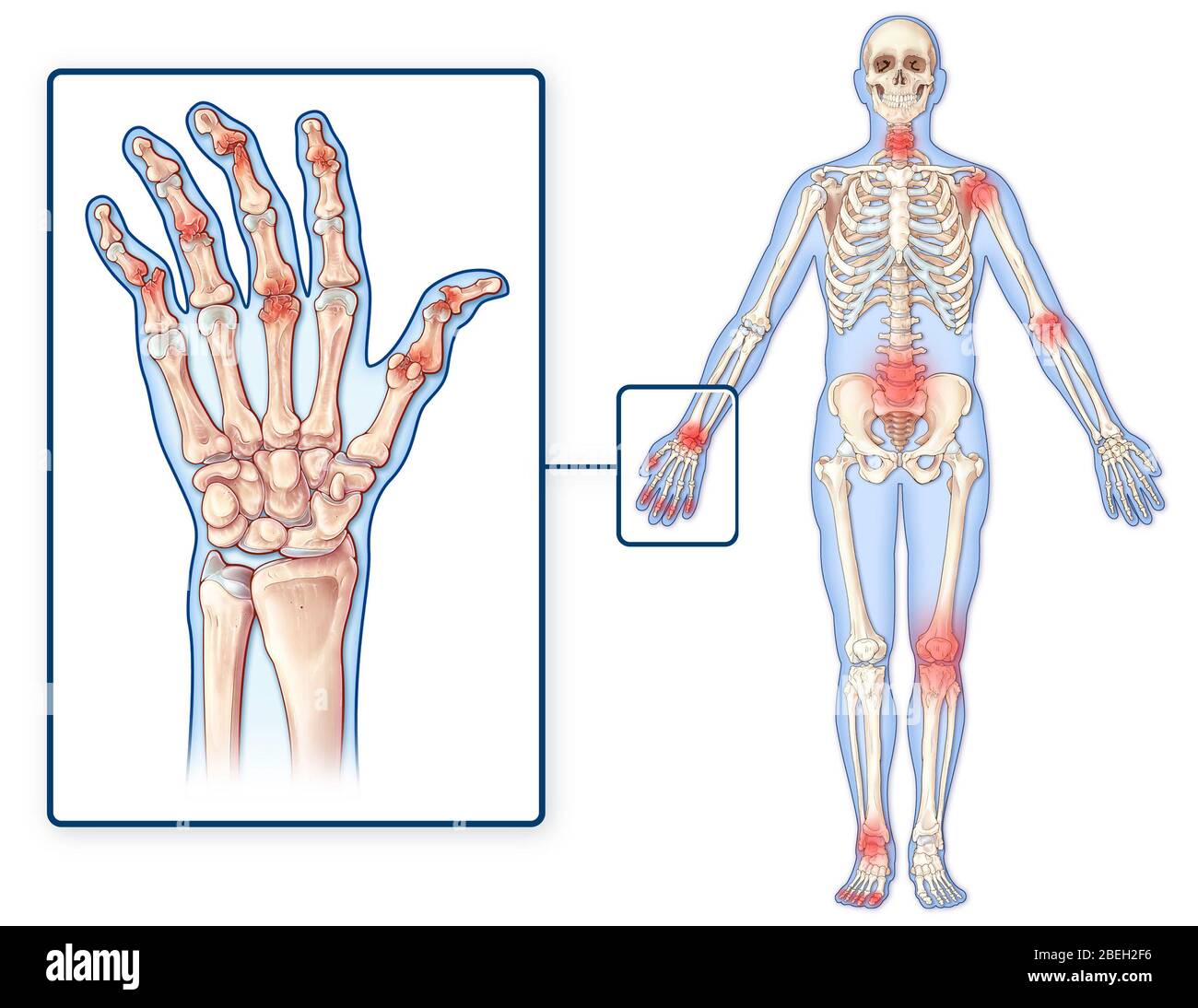 Maladie cutanée inflammatoire chronique Banque d'images détourées - Alamy