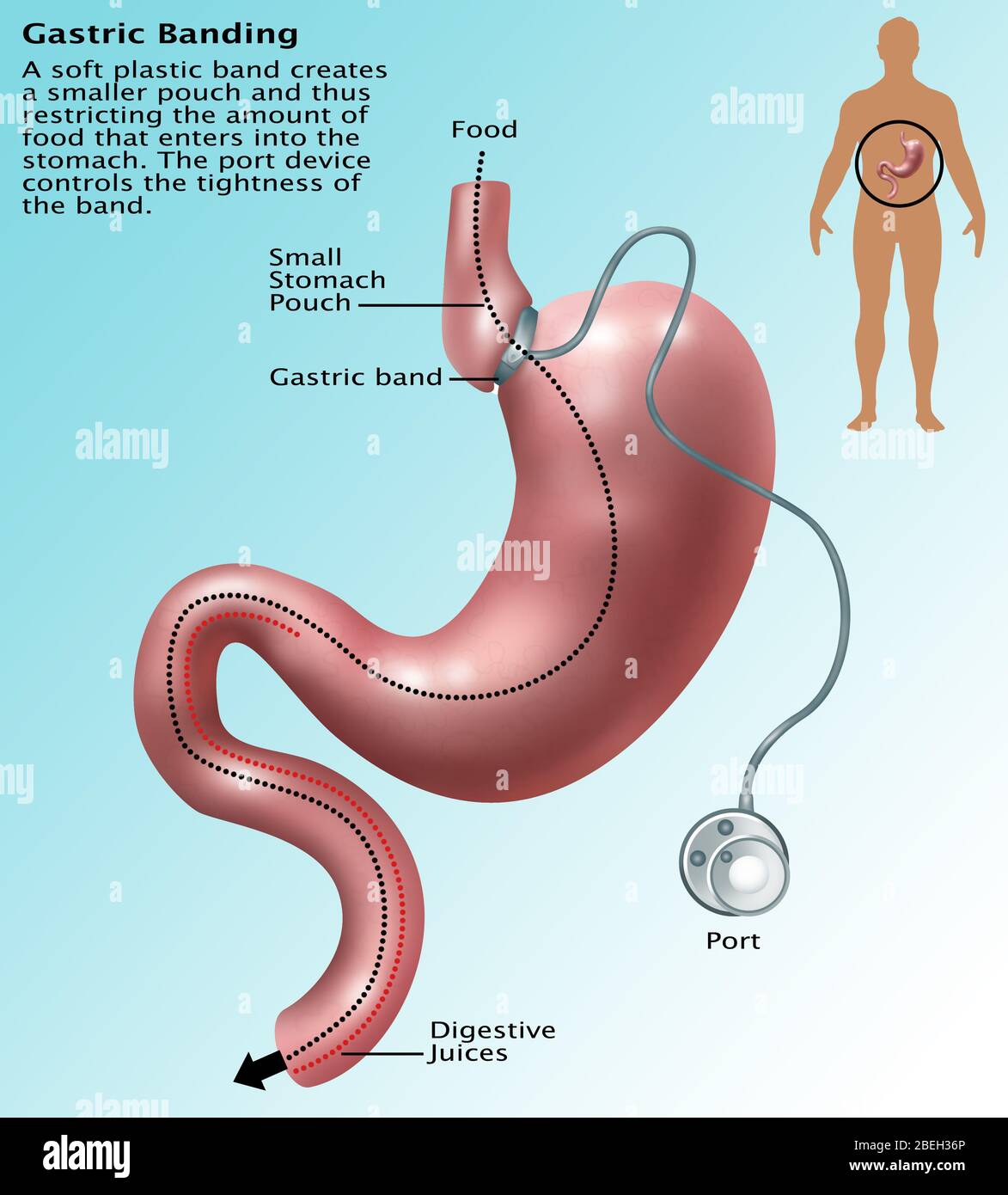 Cerclage gastrique Banque de photographies et d’images à haute résolution - Alamy