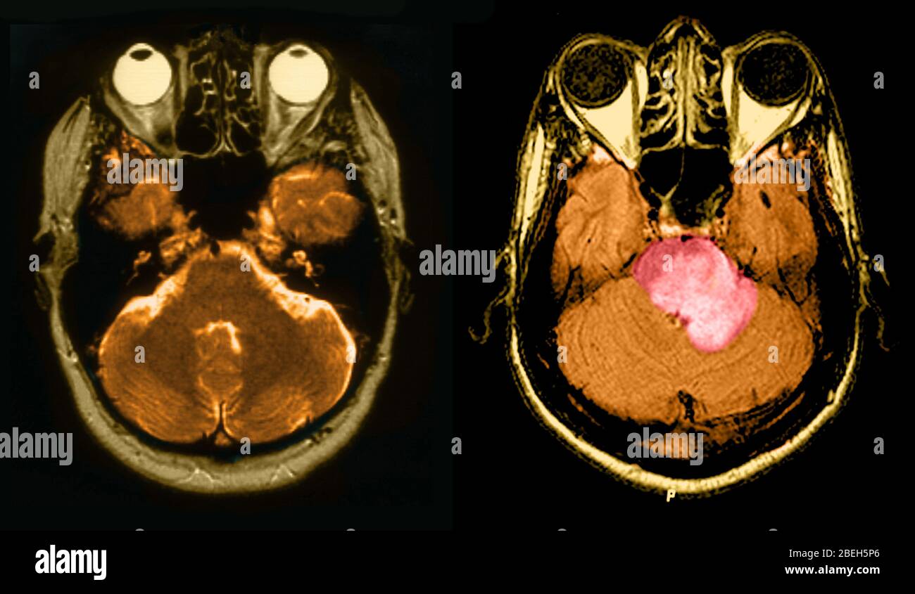 Irm anormal du cerveau Banque de photographies et d’images à haute résolution - Alamy