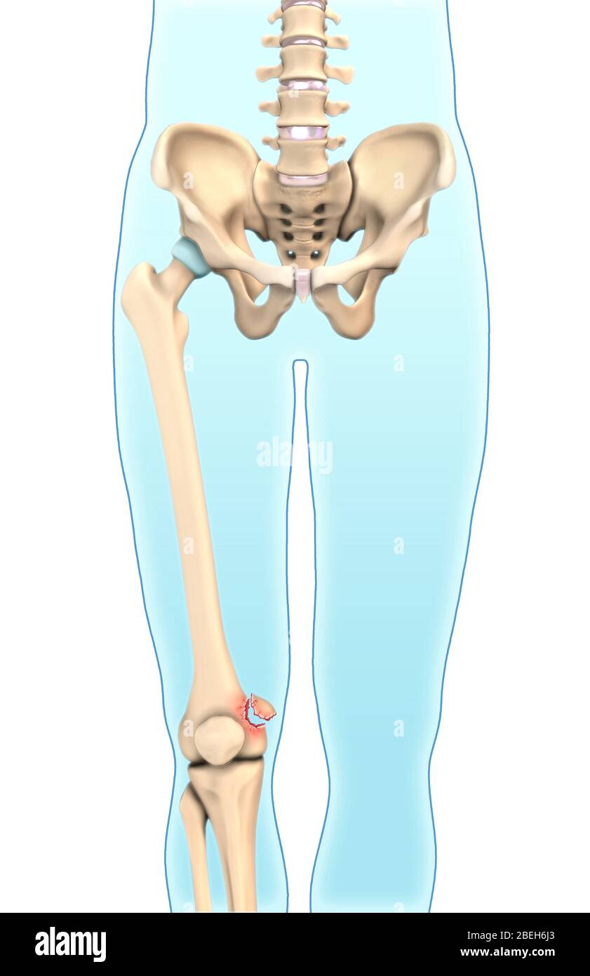 Fracture Osseuse Par Avulsion Banque d'image et photos - Alamy