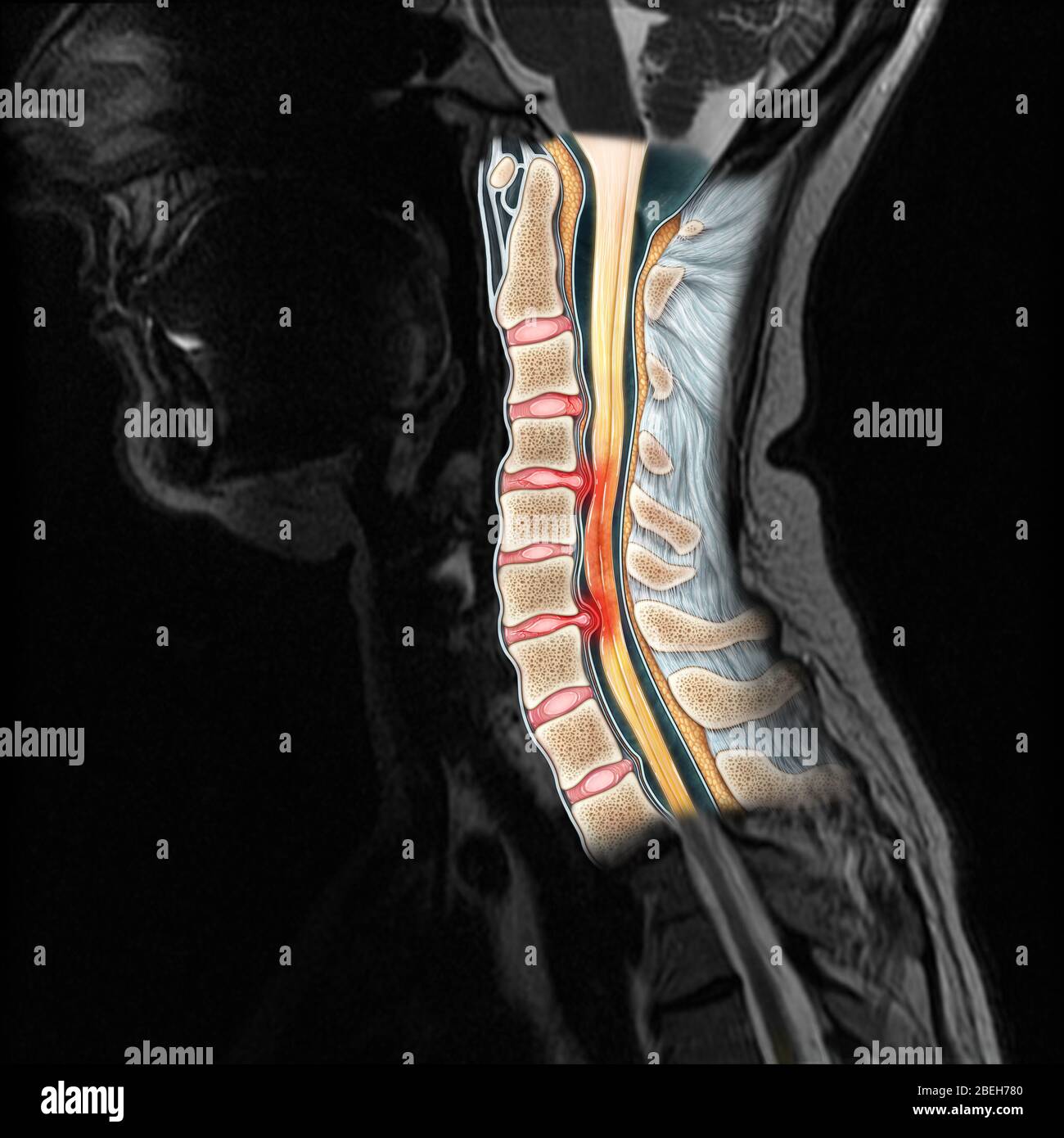 Lésion du rachis cervical, IRM Photo Stock - Alamy